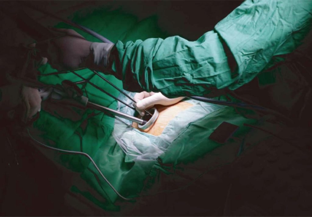 Single Port VATs ด้วย Lagis Wound Retractor – NTN Medical Team